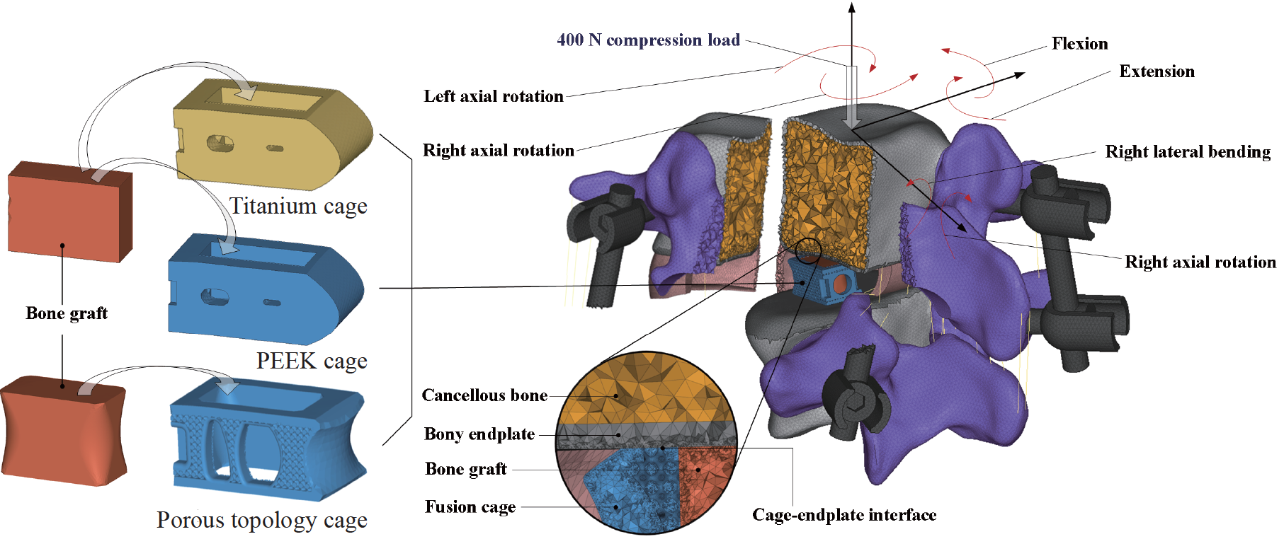 A newly designed personalized interbody fusion cage and its ...