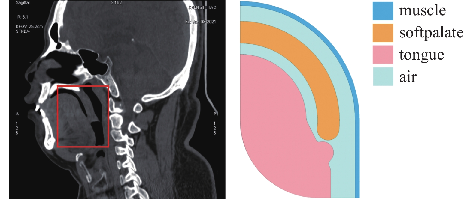 气流作用下气道组织变形的流固耦合研究