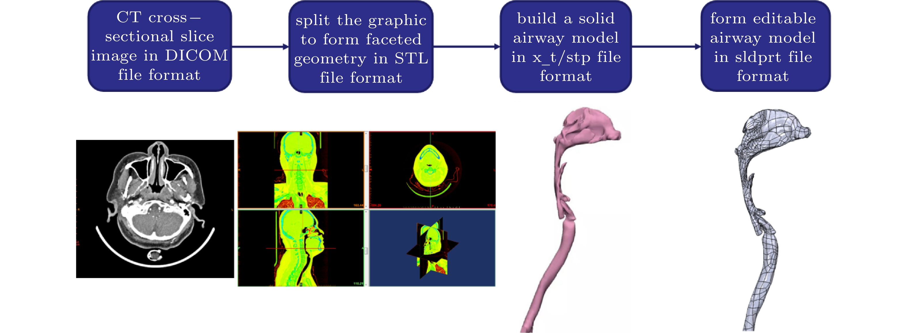 声门下喉气管狭窄分度的数值模拟分析