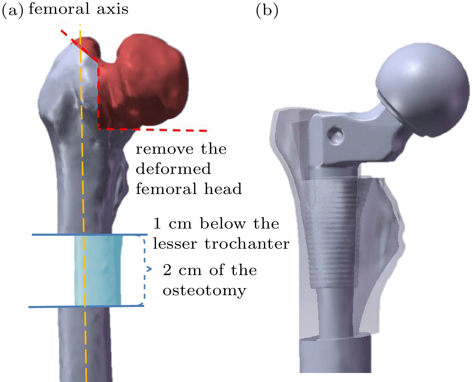 Crowe IV型发育性髋关节发育不良在全髋关节置换术中横行截骨最佳位置的有限元分析